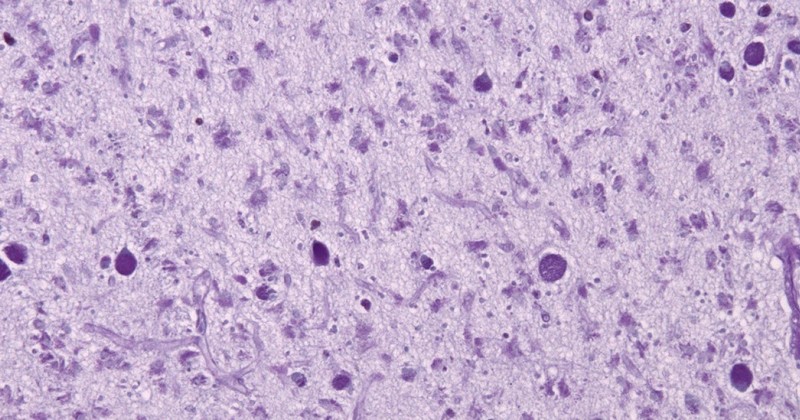 Batten Disease Symptoms Causes And Treatment